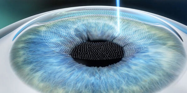 LASIK San Diego | Vision Correction Procedures San Diego, CA | Invision